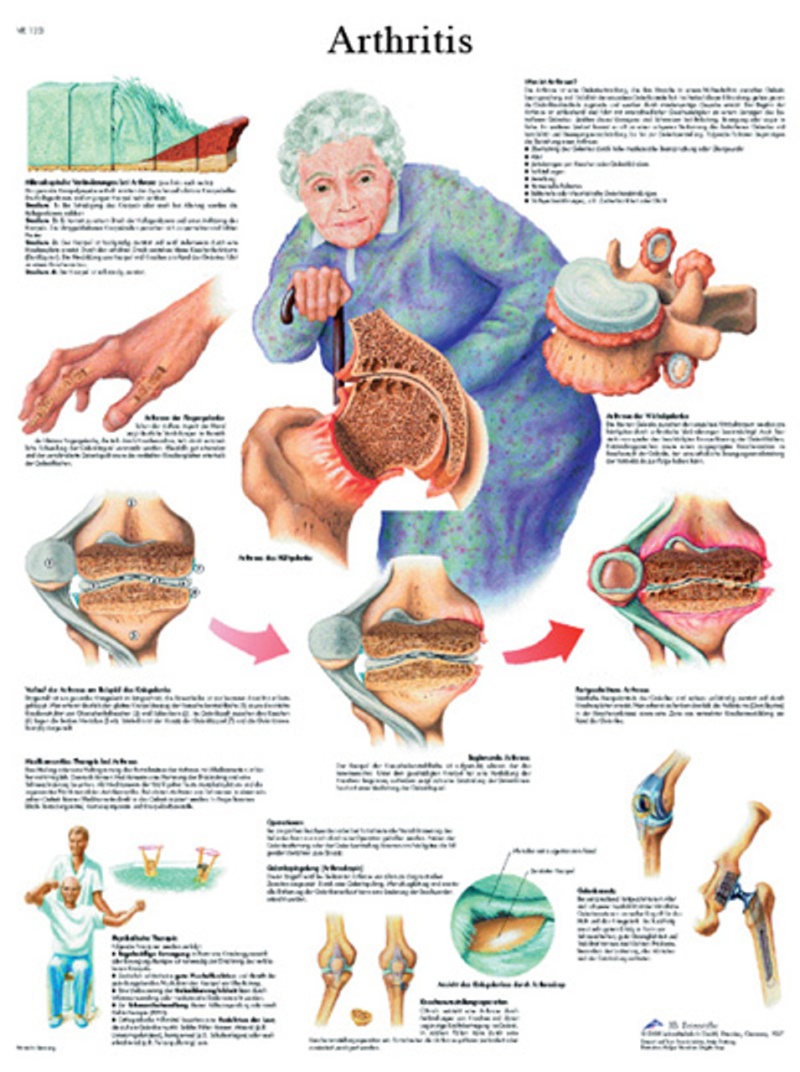 Anatomical Chart - Effects Of Arthritis, Laminated